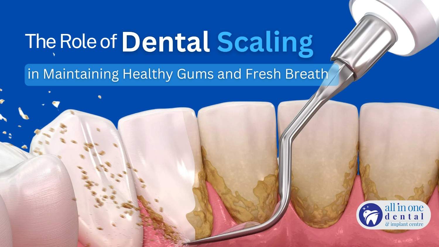 Dental Scaling: Keep Your Gums Healthy & Breath Fresh in 2025
