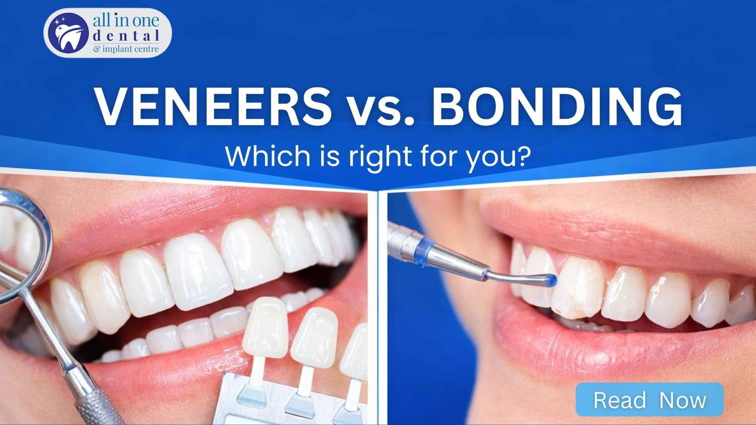 Veneers vs. Bonding: Which is right for you? - All in one Dental